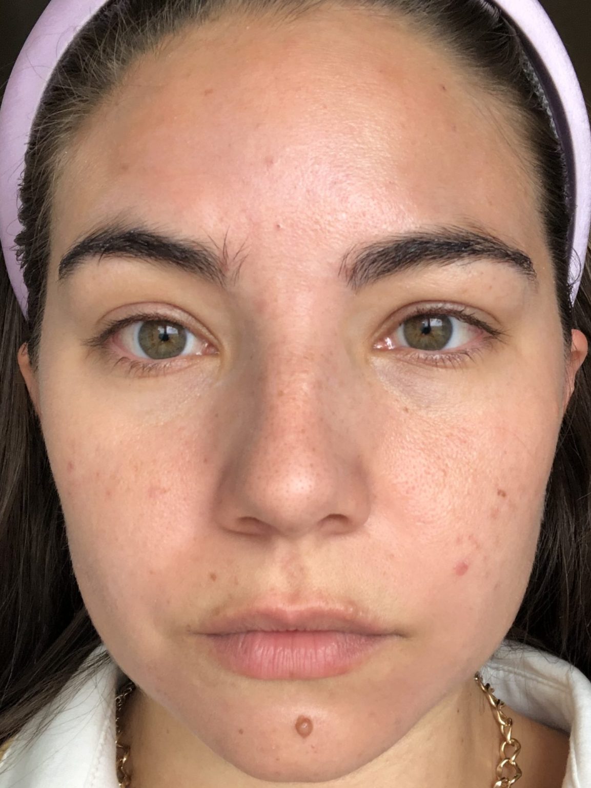 Jessner Chemical Peel: Before/After Photos of the Proven Facial ...