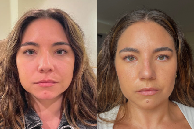 My Experience Receiving Botox for TMJ | Lauryncakes